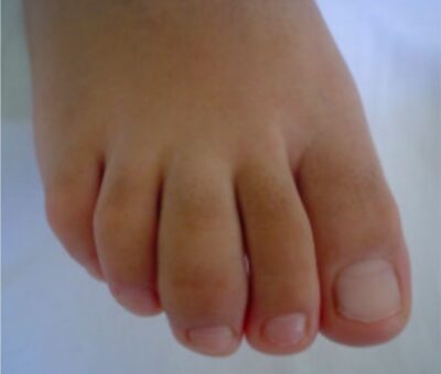 Ankylosing Spondylitis | Concise Medical Knowledge