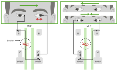Internuclear Ophthalmoplegia | Concise Medical Knowledge