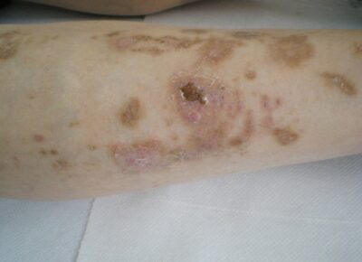 Generalized and Localized Rashes | Concise Medical Knowledge