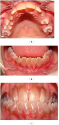Osteogénesis Imperfecta | Concise Medical Knowledge