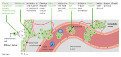 Grading, Staging, and Metastasis | Concise Medical Knowledge