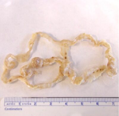 Taenia/Teniasis | Concise Medical Knowledge