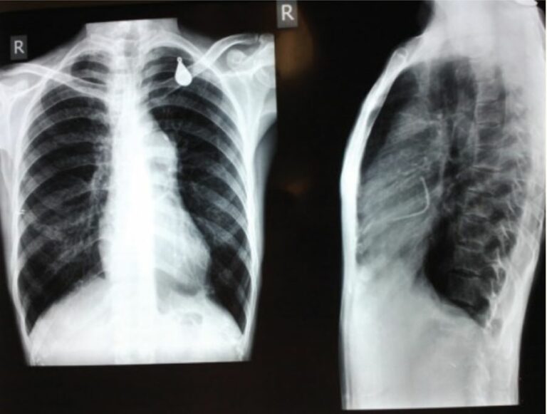 Pulmonary Stenosis | Concise Medical Knowledge