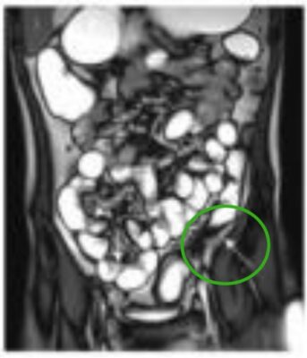 Doença de Crohn | Concise Medical Knowledge