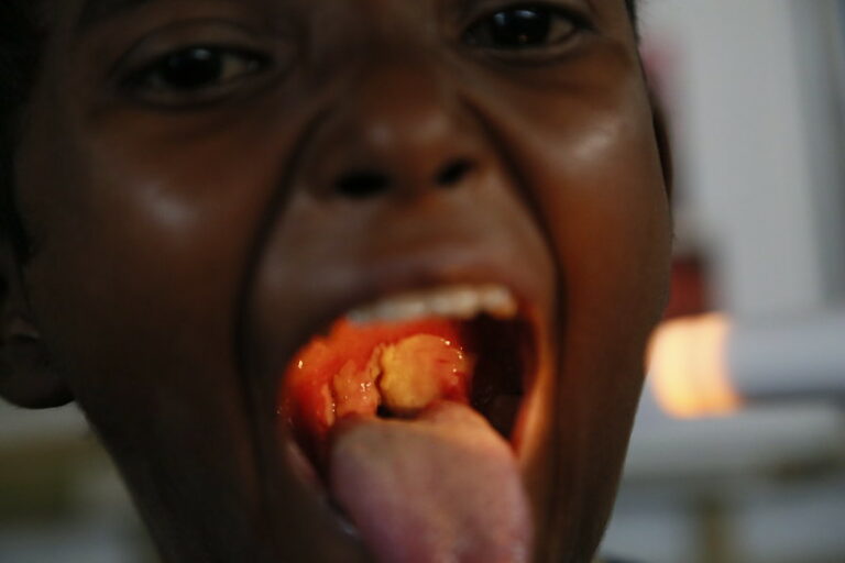 Diphtheria | Concise Medical Knowledge