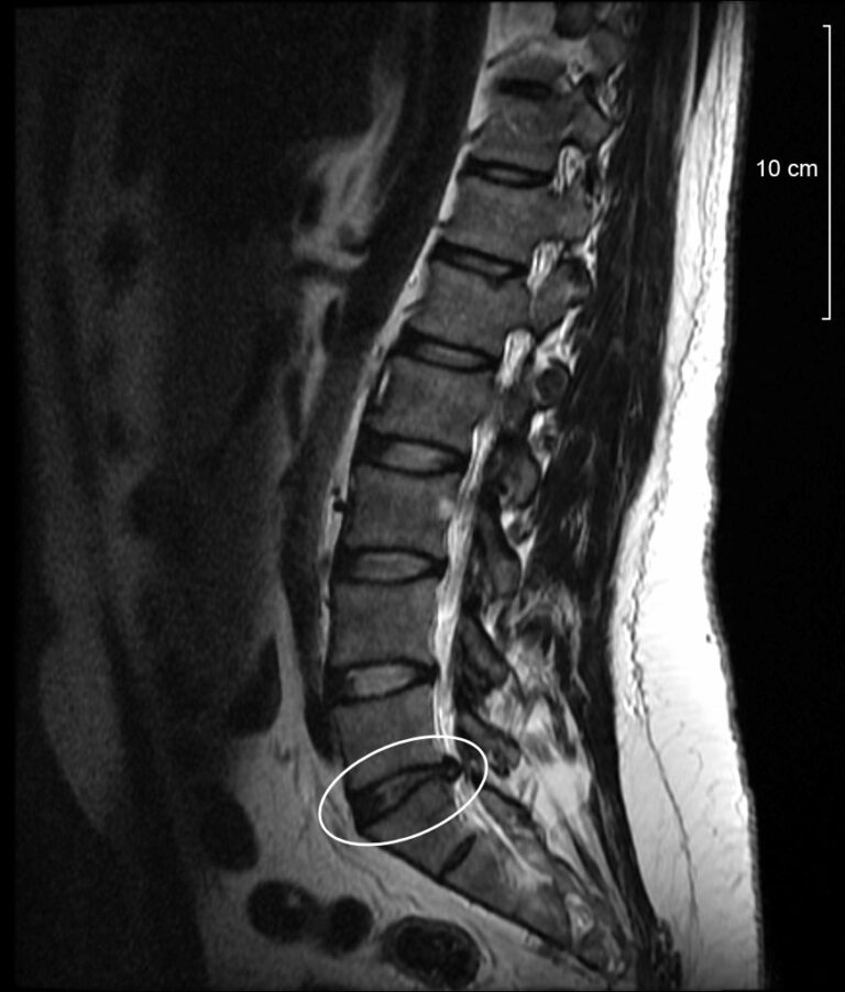 Imaging of the Spine and Spinal Cord | Concise Medical Knowledge