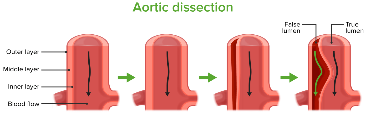 Dissection of the Carotid and Vertebral Arteries | Concise Medical ...
