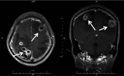 Nocardia/Nocardiosis | Concise Medical Knowledge