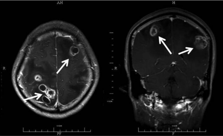 Nocardia/Nocardiosis | Concise Medical Knowledge