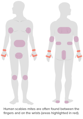 Scabies | Concise Medical Knowledge