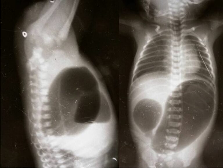 Congenital Duodenal Obstruction | Concise Medical Knowledge