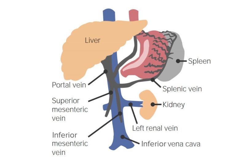 Esplenomegalia | Concise Medical Knowledge