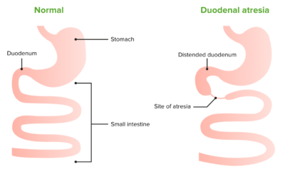 Congenital Duodenal Obstruction | Concise Medical Knowledge
