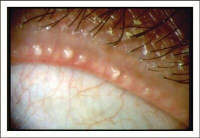 Blepharitis | Concise Medical Knowledge