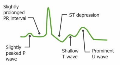 Hypokalemia | Concise Medical Knowledge