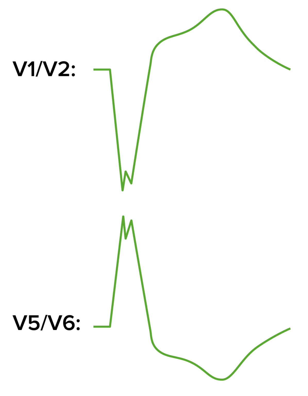 Bundle Branch and Fascicular Blocks | Concise Medical Knowledge