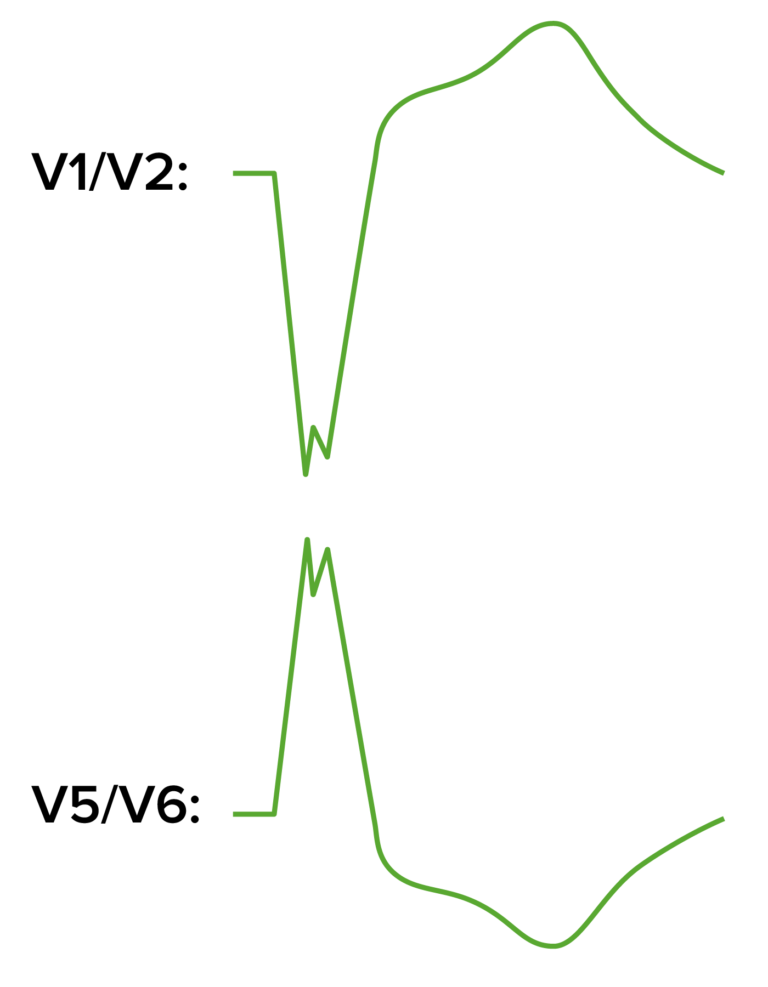 Bundle Branch and Fascicular Blocks | Concise Medical Knowledge