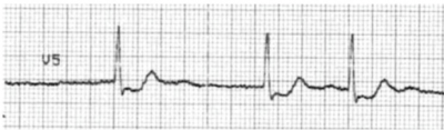 Cardiac Glycosides | Concise Medical Knowledge