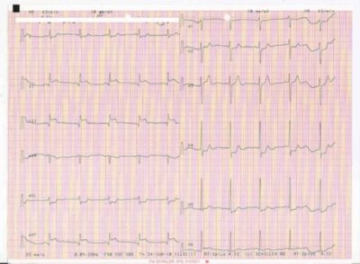 Myocardial Infarction | Concise Medical Knowledge
