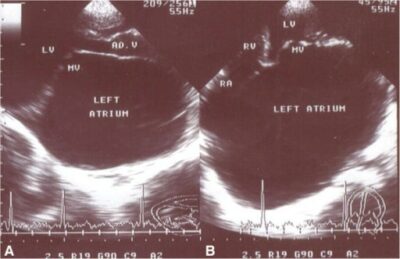 Mitral Stenosis | Concise Medical Knowledge