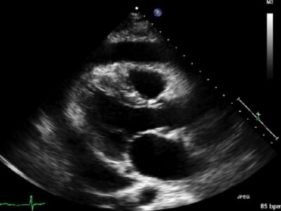 Pericardial Effusion and Cardiac Tamponade | Concise Medical Knowledge