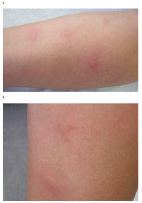 Generalized and Localized Rashes | Concise Medical Knowledge