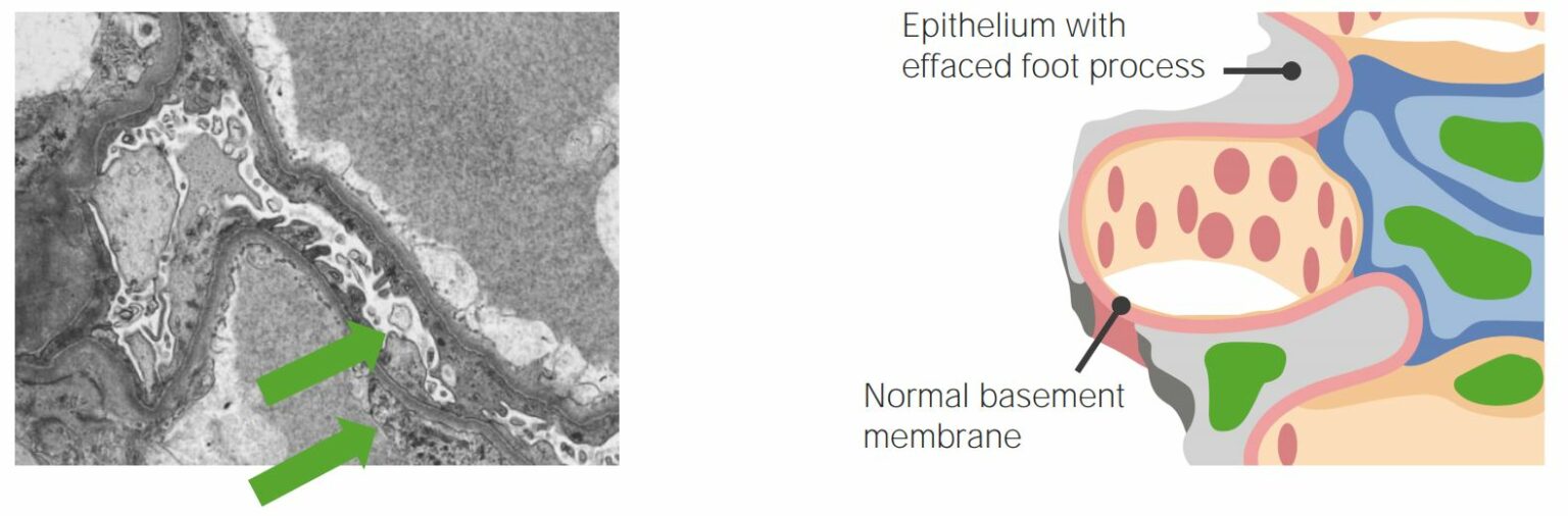 Minimal Change Disease | Concise Medical Knowledge