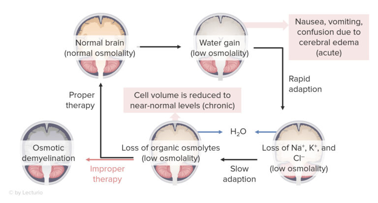 Hyponatremia Clinical Concise Medical Knowledge