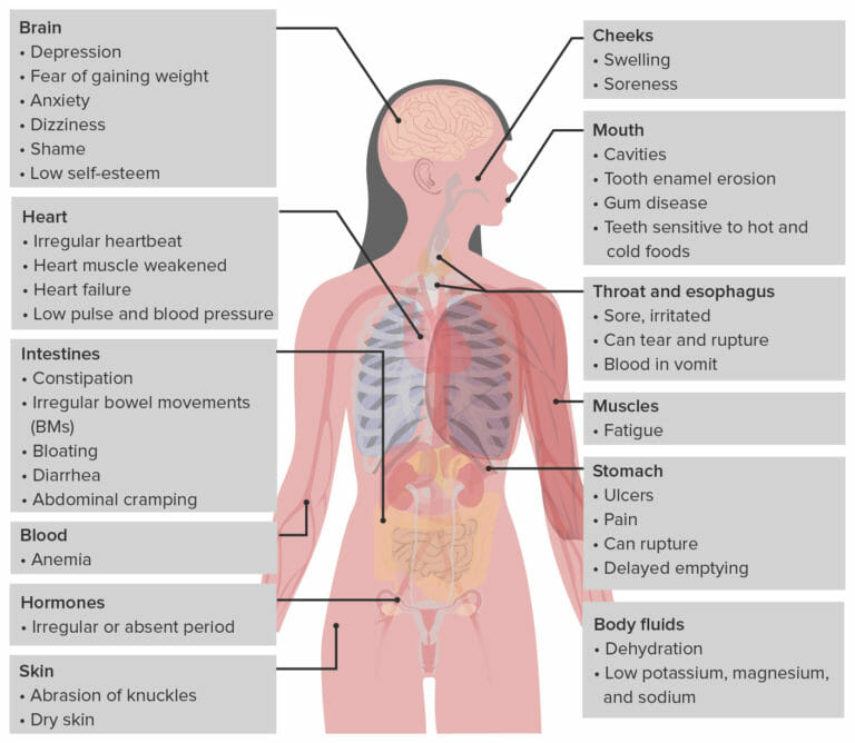 Bulimia Nervosa | Concise Medical Knowledge Bulimia Nervosa | Concise Medical Knowledge