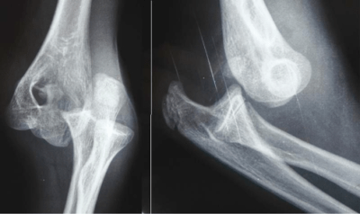 Luxación del Codo | Concise Medical Knowledge