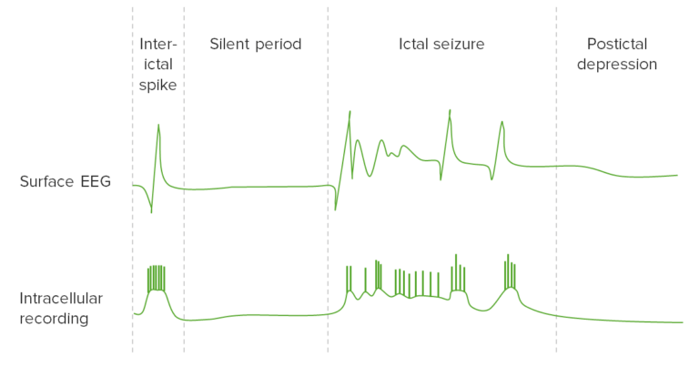 Seizures | Concise Medical Knowledge
