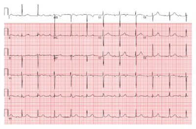 Endocarditis | Concise Medical Knowledge