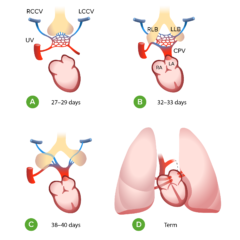 Total Anomalous Pulmonary Venous Return (TAPVR) | Concise Medical Knowledge