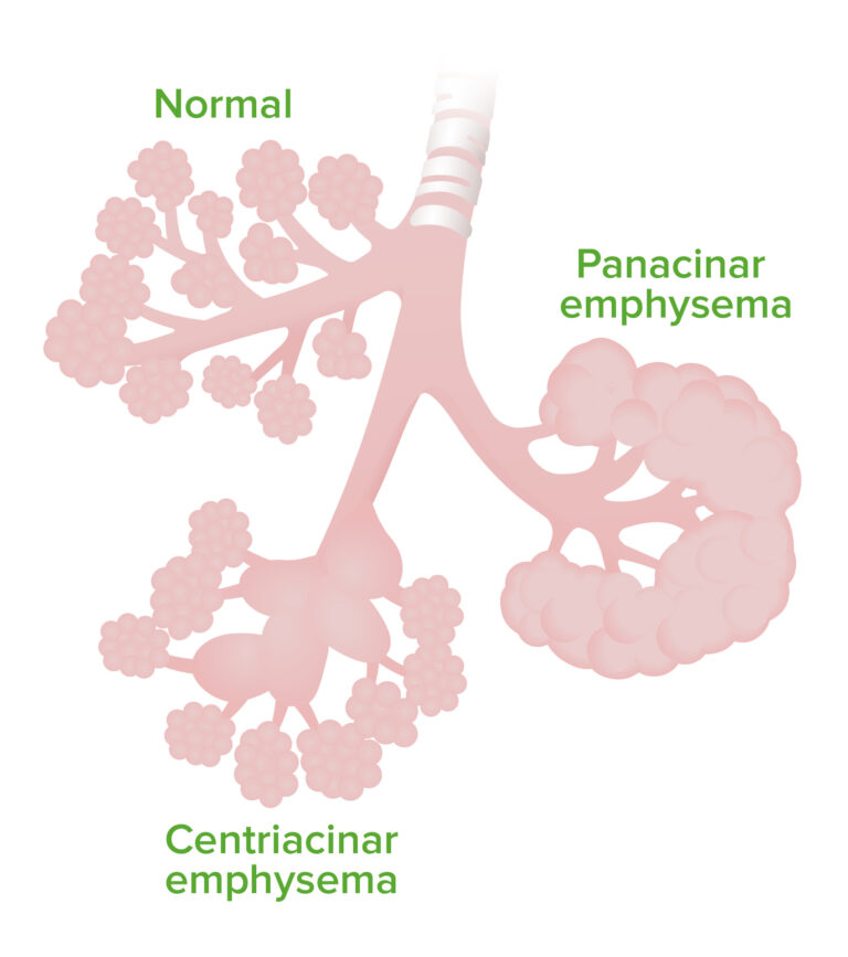 Chronic Obstructive Pulmonary Disease (COPD) | Concise Medical Knowledge