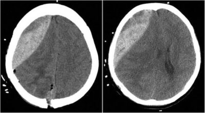 Hemorragia Epidural | Concise Medical Knowledge