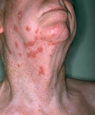 Herpes Zoster (Shingles) | Concise Medical Knowledge