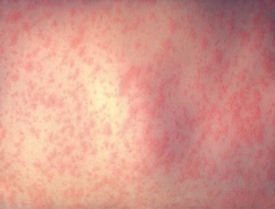Rubella Virus | Concise Medical Knowledge