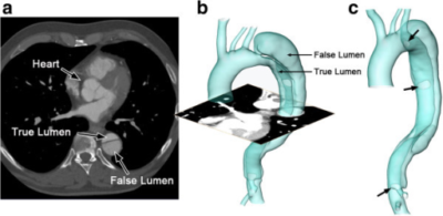 Aortic Dissection | Concise Medical Knowledge