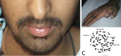 Aplastic Anemia | Concise Medical Knowledge