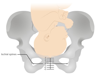 Complicaciones Durante el Parto | Concise Medical Knowledge