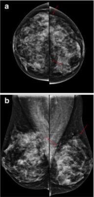 Fibrocystic Change | Concise Medical Knowledge