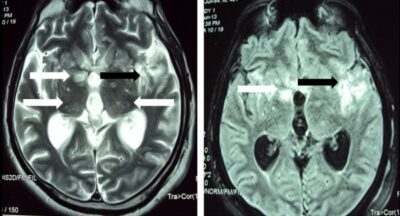 Cryptococcus/Criptococose | Concise Medical Knowledge