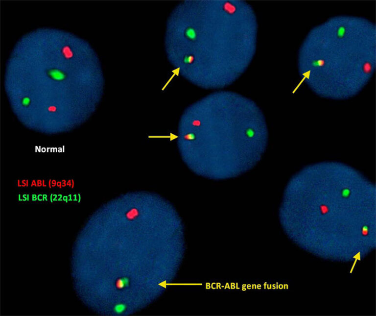 Leucemia Mielóide Crónica | Concise Medical Knowledge