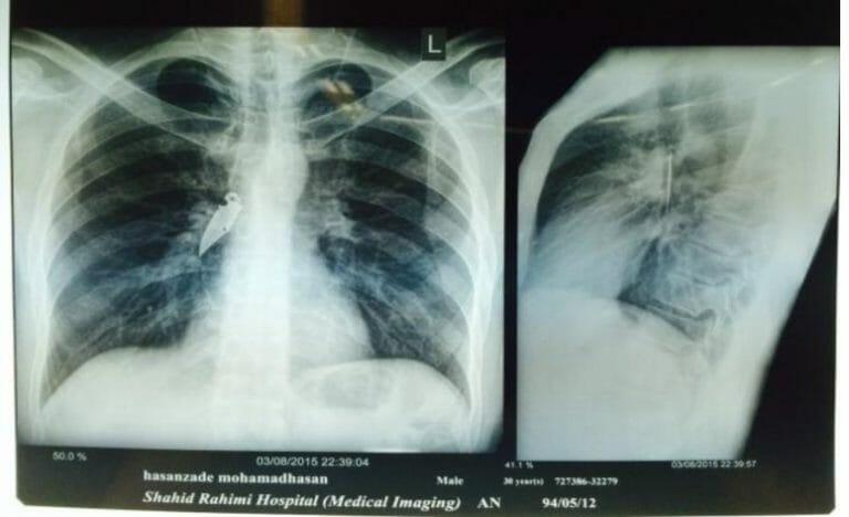 Anomalias Torácicas Pediátricas | Concise Medical Knowledge