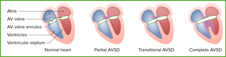 Atrioventricular Septal Defect (AVSD) | Concise Medical Knowledge