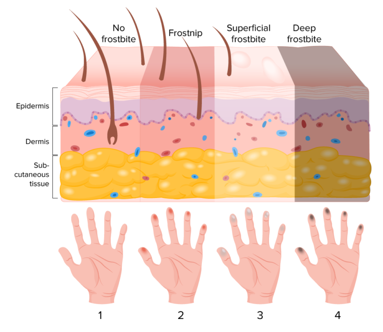 Frostbite | Concise Medical Knowledge