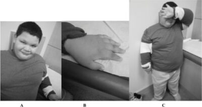 Fragile X Syndrome | Concise Medical Knowledge