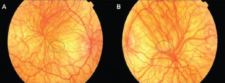 Albinism [+video] - Lecturio Medical