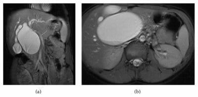 Colestasis en Neonatos y Lactantes Pequeños | Concise Medical Knowledge
