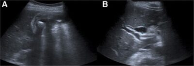 Colangitis Aguda | Concise Medical Knowledge
